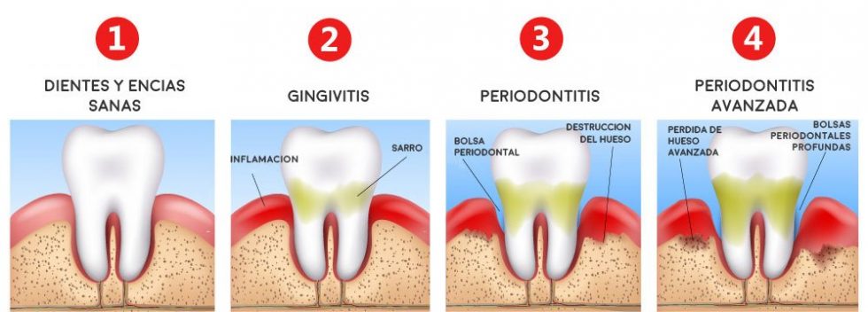 periodontitis archivos - Clínica Dental CEOSC